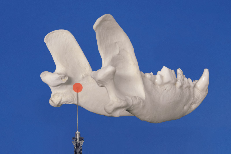 Caudale inferieure alveolaire zenuwblokkade